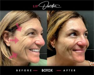 Botox® Treatments - Lip Doctor | Book an Appointment