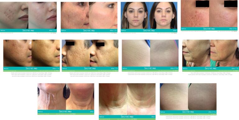 Morpheus8 & Secret Pro - Lip Doctor | Ultimate Skin Transformation